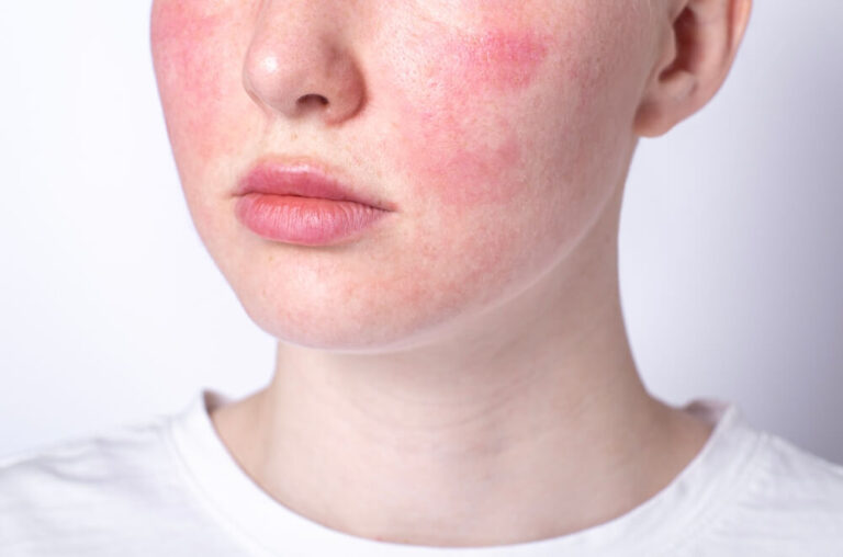 Soolantra Cream for Rosacea | MediClick Pharmacy