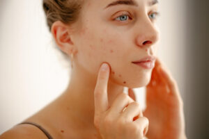 Treclin Gel for Acne | MediClick Pharmacy